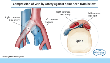 Iliac Vein Compression | Venous Stent